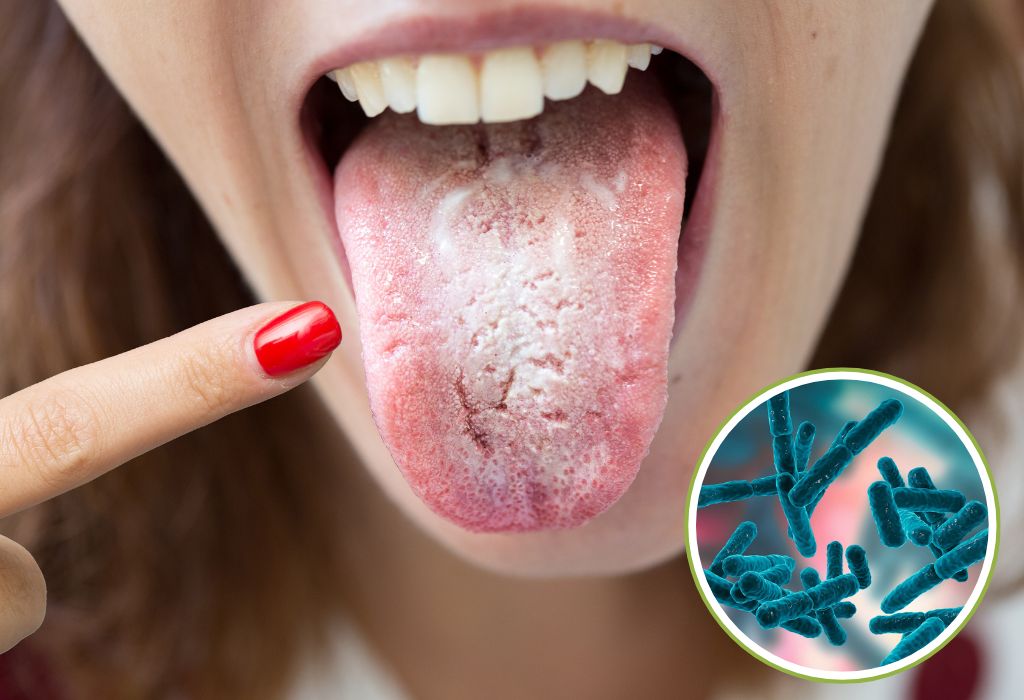 Can Probiotics Help With Thrush? What You Need to Know – Vinatura ...